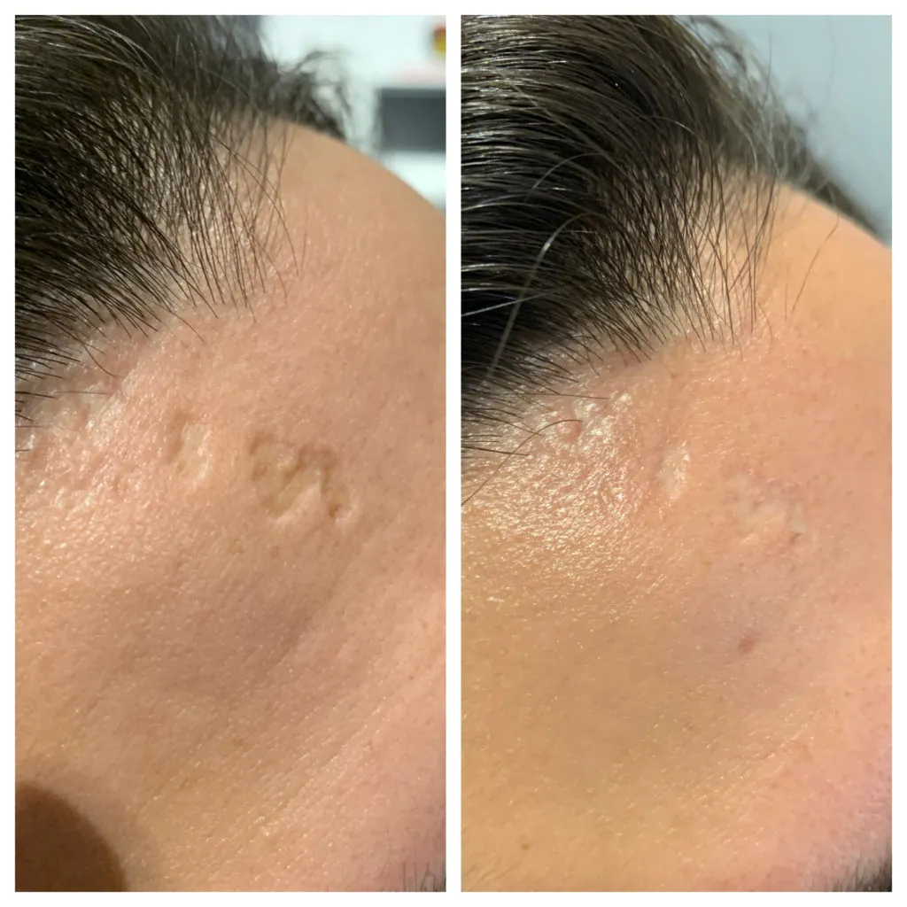 Before and After Photos | Cascade Medical Spa Portland