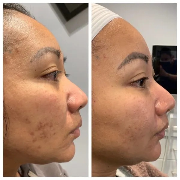 Before and After Photos | Cascade Medical Spa Portland