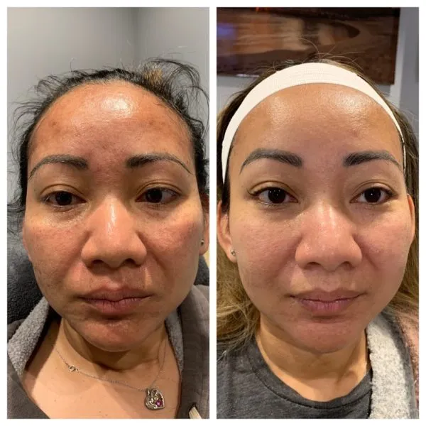Before and After Photos | Cascade Medical Spa Portland
