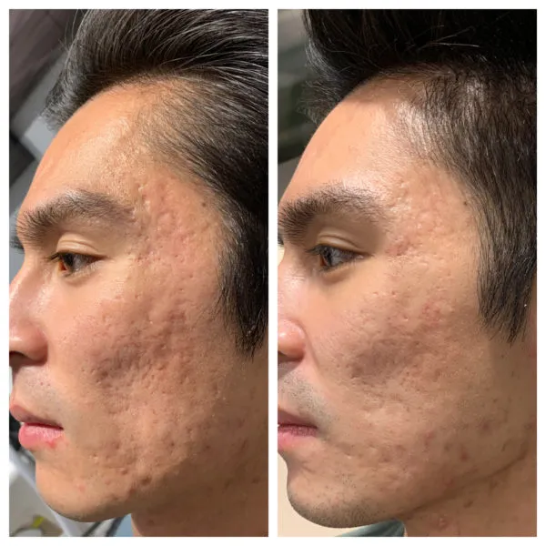 Before and After Photos | Cascade Medical Spa Portland