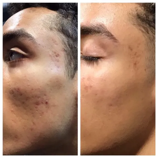 Before and After Photos | Cascade Medical Spa Portland